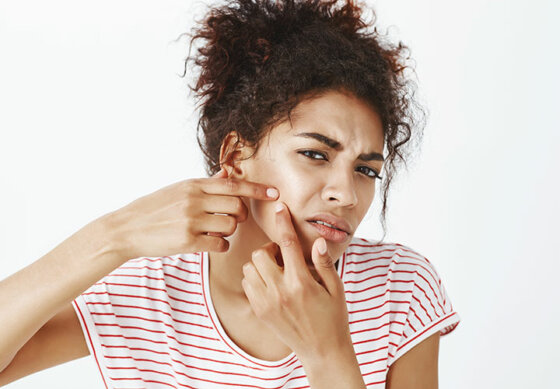 How I Deal With My Acne-Prone Dry and Sensitive Skin